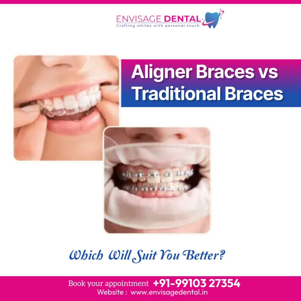 Aligner Braces vs Traditional Braces- Which Will Suit You Better ...